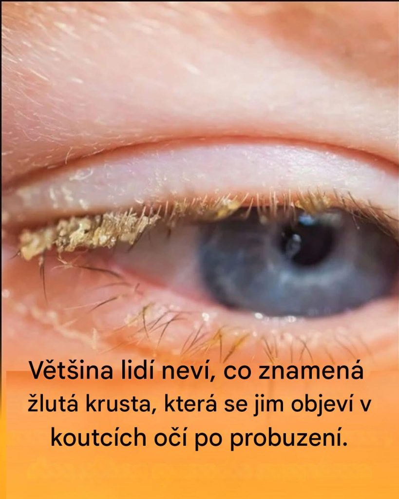 Většina lidí neví, co znamená žlutá krusta, která se jim po probuzení ...